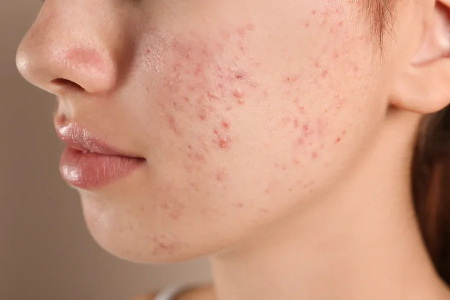 What’s Inside Pimple Purge The Acne-Fighting Ingredients That Matter
